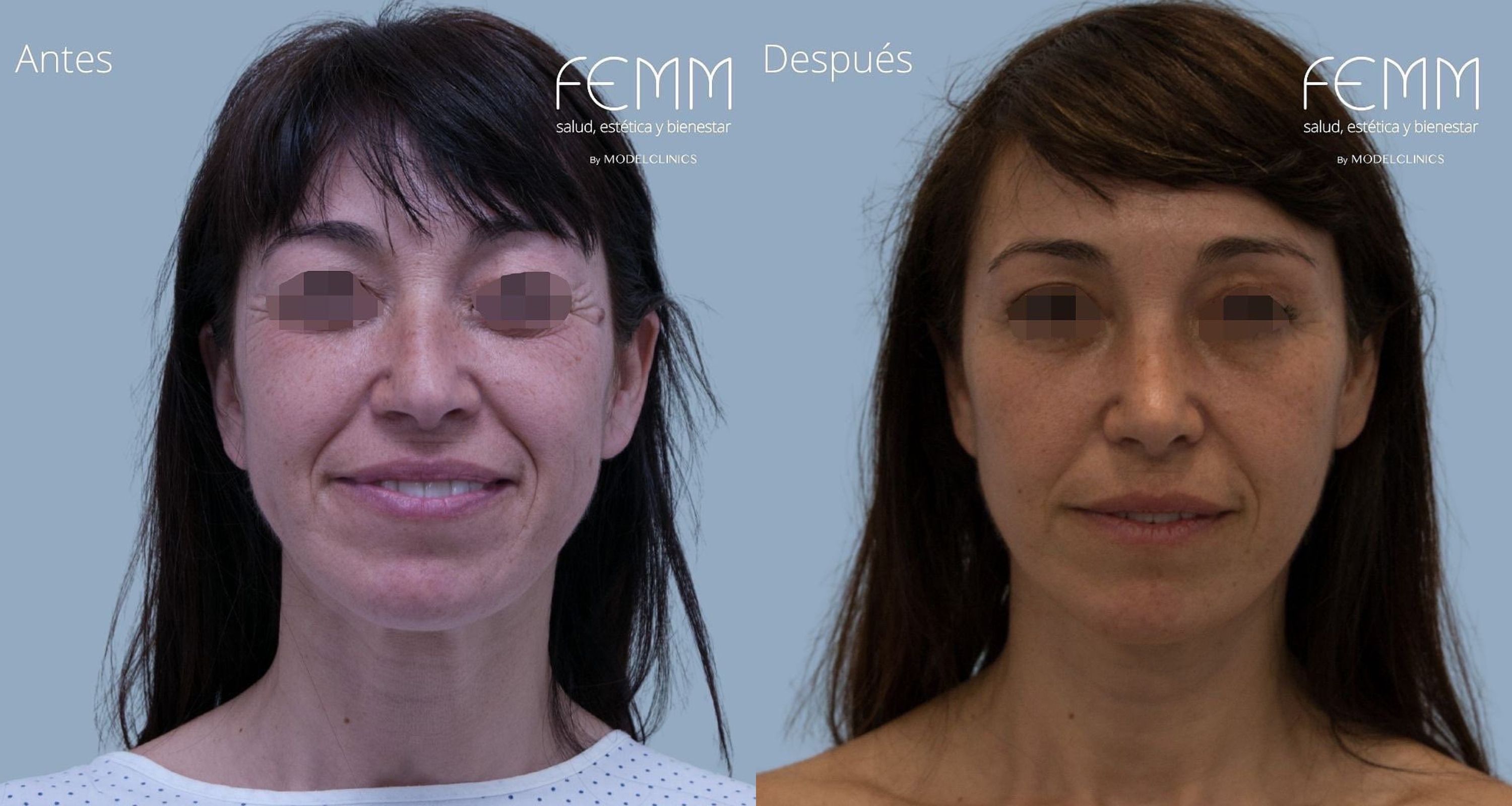 Lipofilling Antes y después - Multiestetica.com
