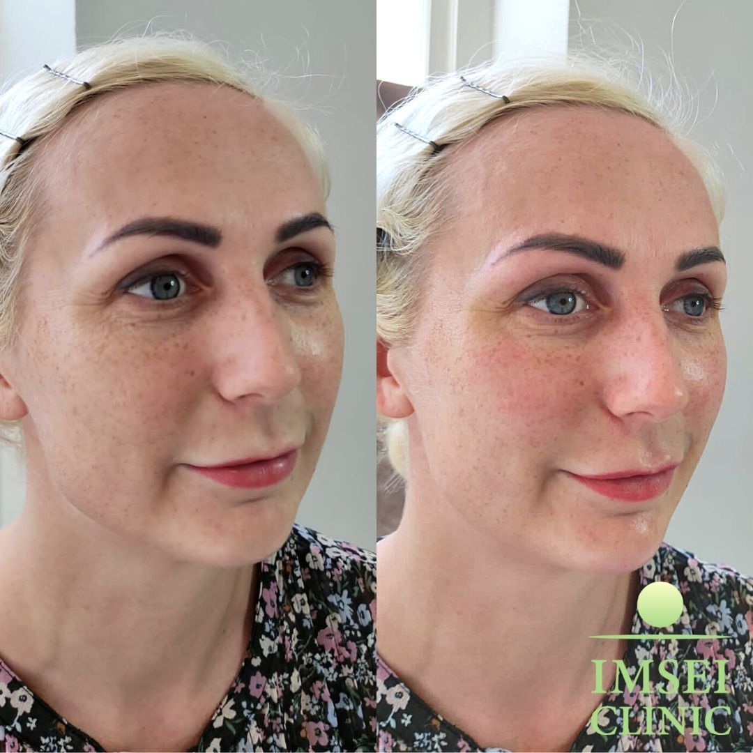 Aumento pómulos Antes y después - Multiestetica.com