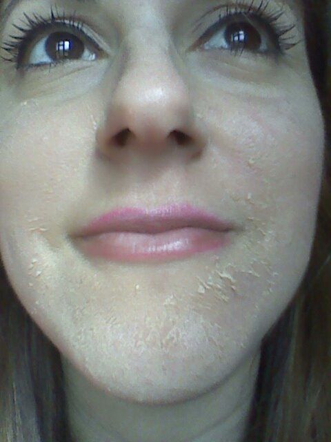 Aumento de labios y peeling de acné - Aumento labios - Multiestetica.com