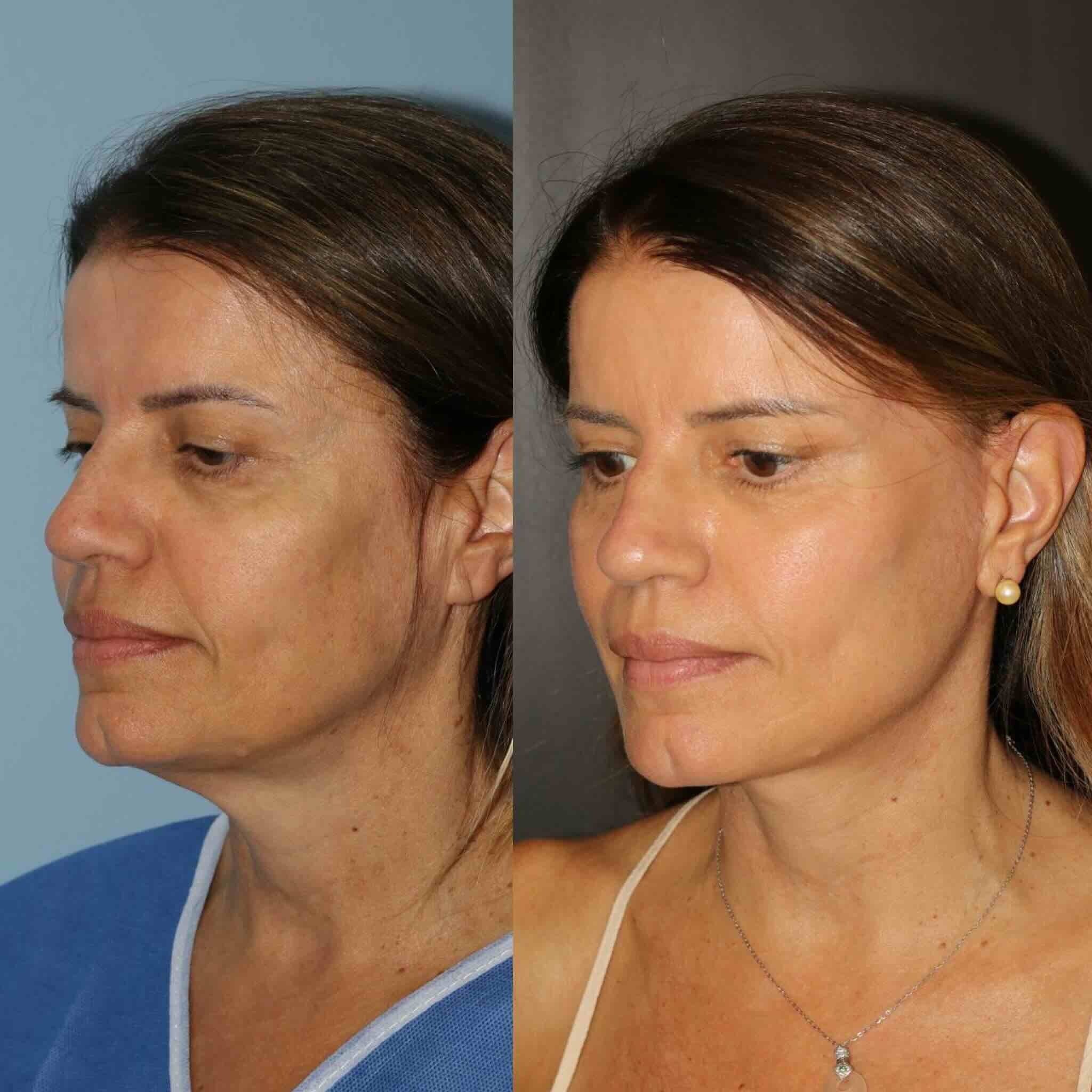 Lifting cervicofacial con técnica Deep Plane 3R. Un cambio real, sin ...