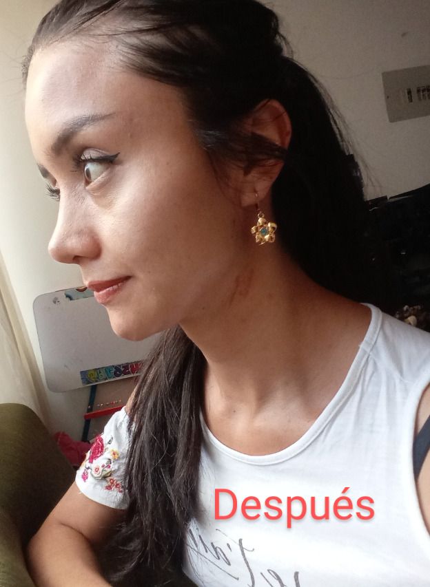Nariz muy respingada -estoy preocupada - Rinoplastia - Multiestetica.com