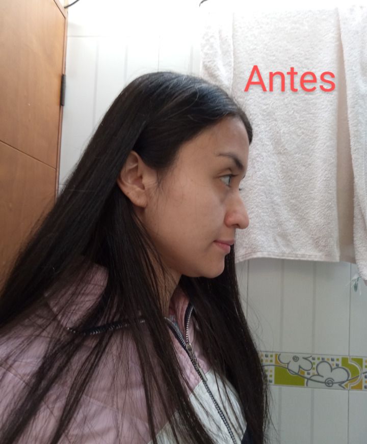 Nariz muy respingada -estoy preocupada - Rinoplastia - Multiestetica.com