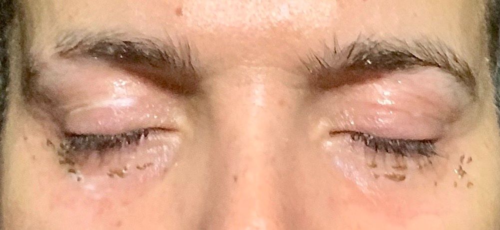 Resultados después de 24 días de la blefaroplastia con láser Plasmage ...