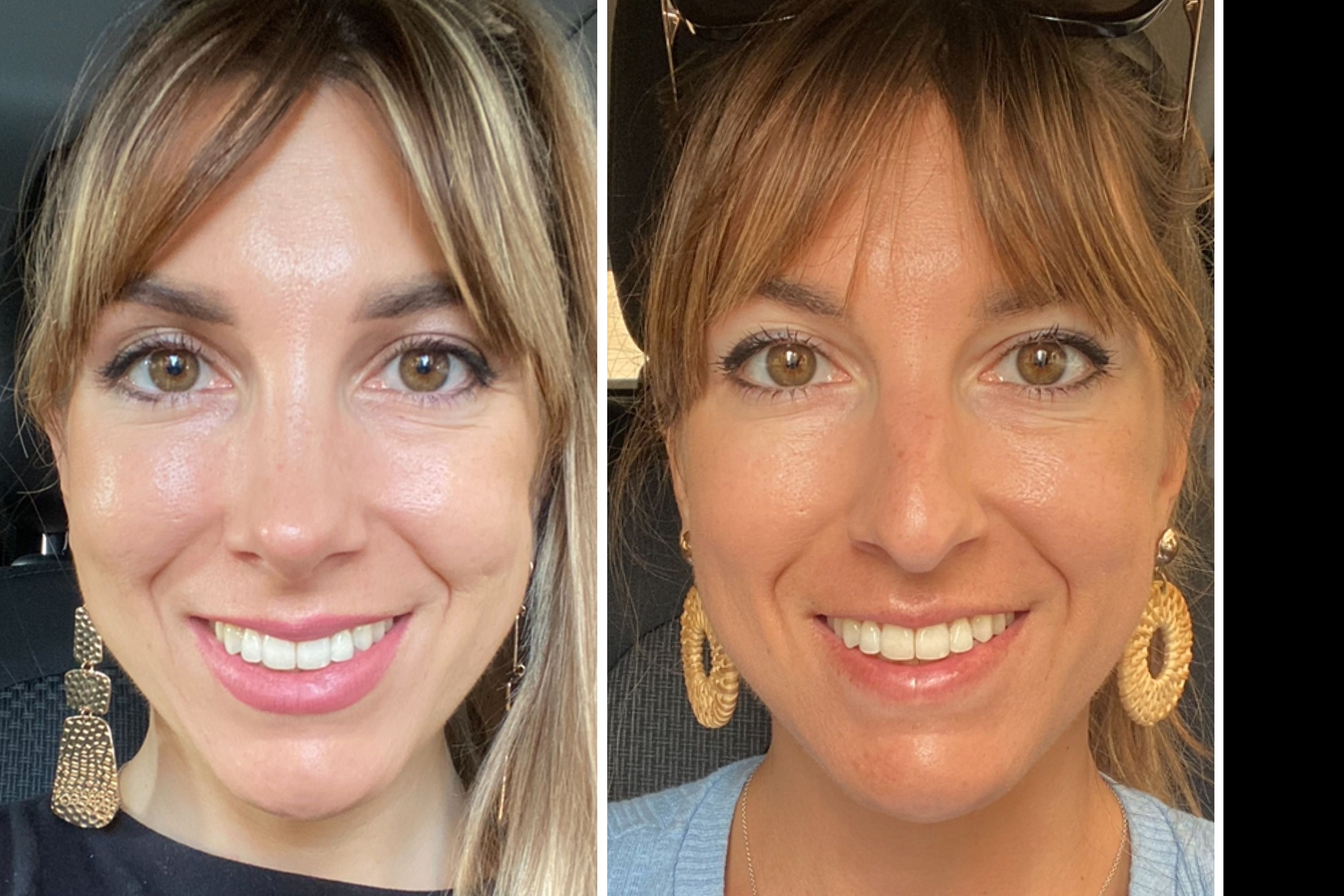 Nariz perfecta - Dr Ramon Tarragona (cl planas) - Rinoplastia ...