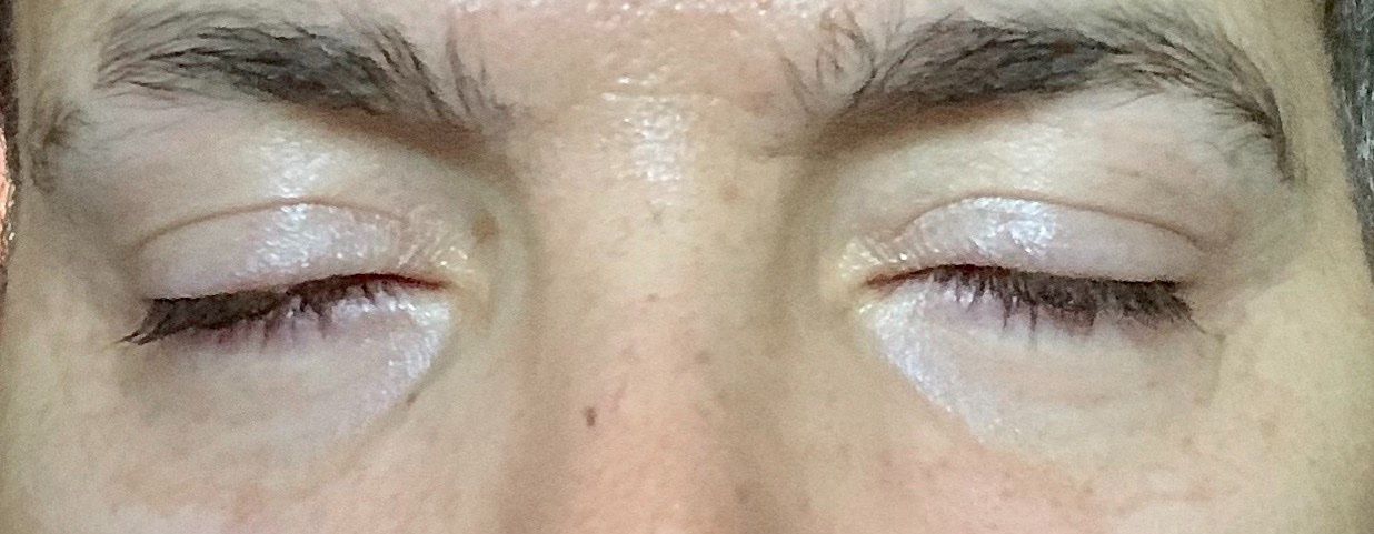 Resultados después de 24 días de la blefaroplastia con láser Plasmage ...