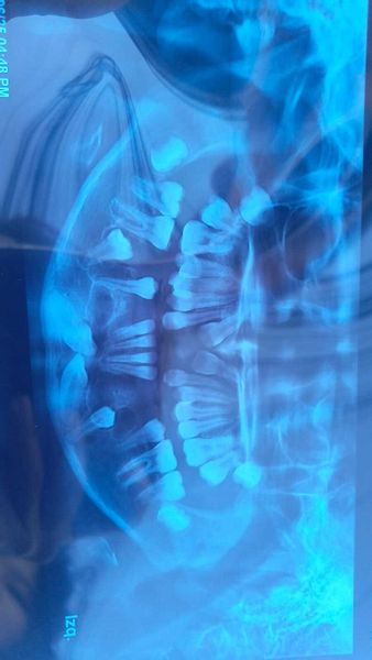 Extracción de dientes supernumerarios, Mar4217, sept 2025