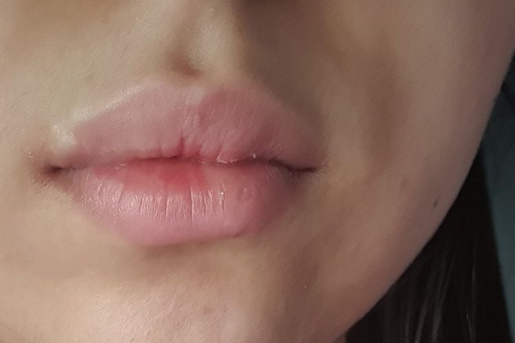 tratamiento para cicatriz deprimida en el labio superior ...