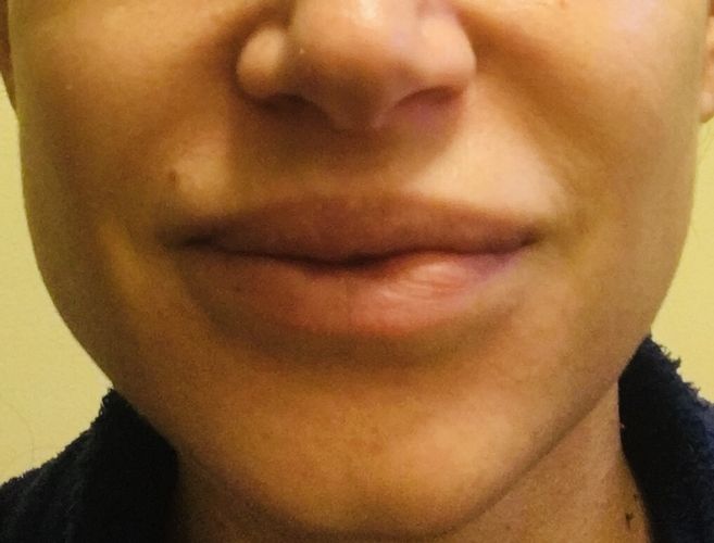 Tratamientos para granuloma en los labios por ácido hialurónico ...