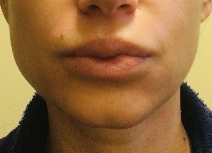 Tratamientos para granuloma en los labios por ácido hialurónico ...