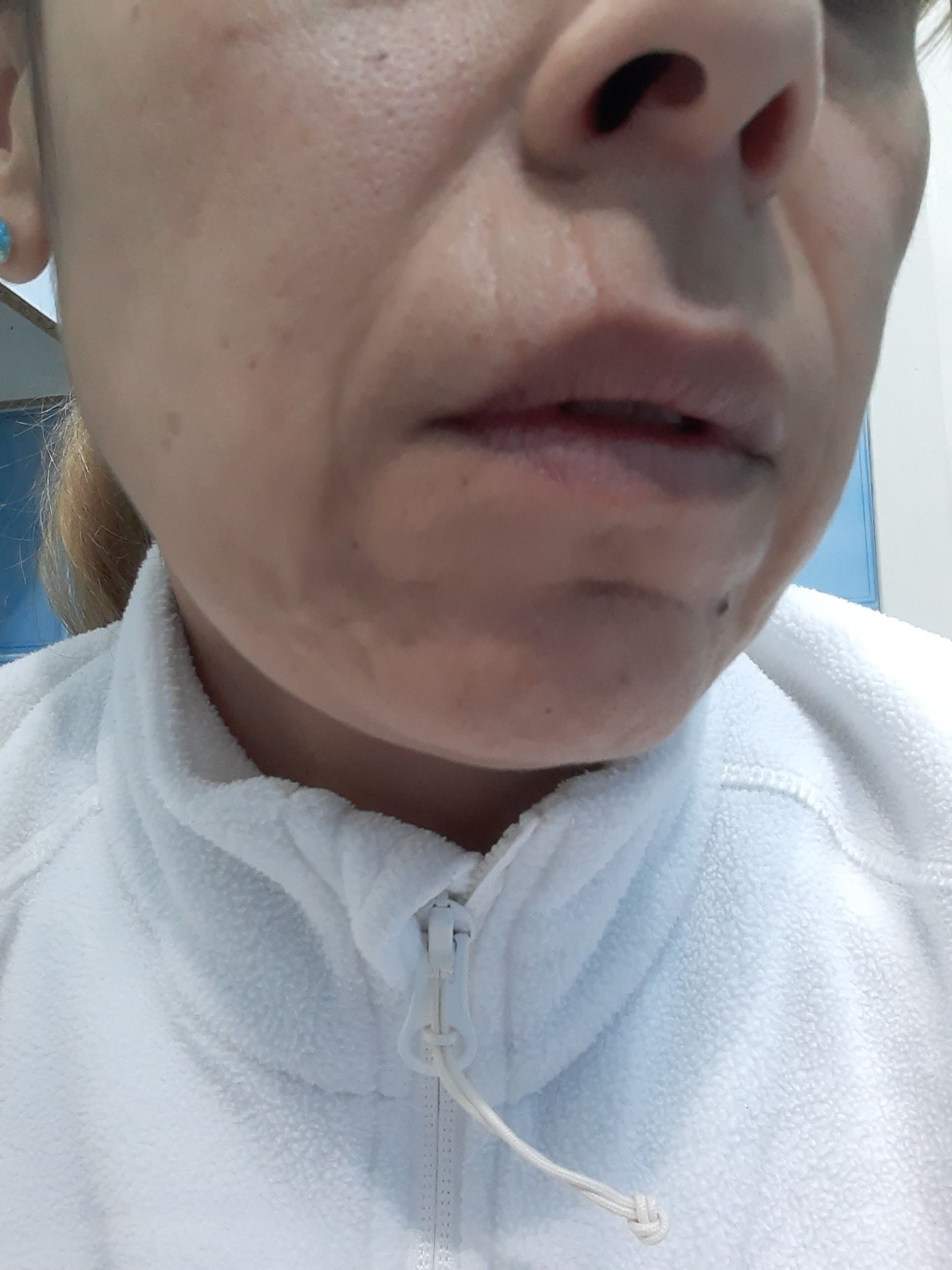 Eliminar cicatriz deprimida muy notoria en labio superior ...