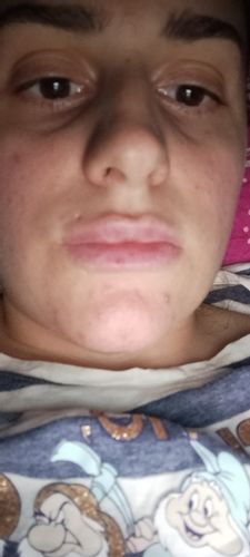 Labio superior inflamado tras 12 días inyección de Ácido Hialurónico ...