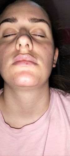 Labio superior inflamado tras 12 días inyección de Ácido Hialurónico ...