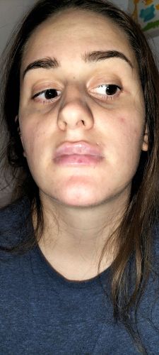 Labio superior inflamado tras 12 días inyección de Ácido Hialurónico ...