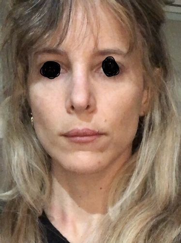 Fibrosis y bola en punta nasal tras 6 meses de rinoplastia ...