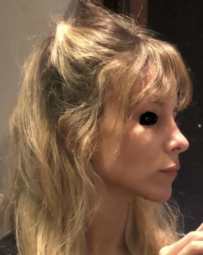 Fibrosis y bola en punta nasal tras 6 meses de rinoplastia ...