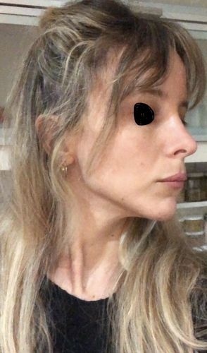 Fibrosis y bola en punta nasal tras 6 meses de rinoplastia ...