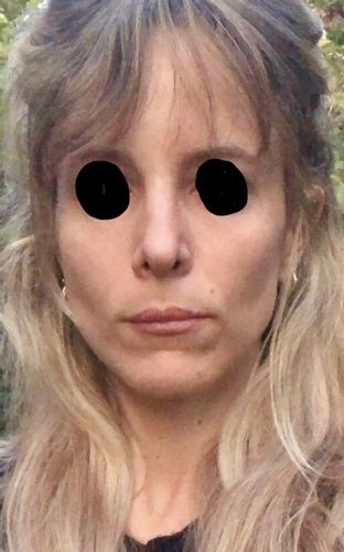 Fibrosis y bola en punta nasal tras 6 meses de rinoplastia ...