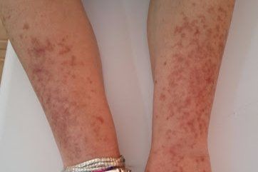 ¿Cómo quitar manchas en los brazos? - Multiestetica.com